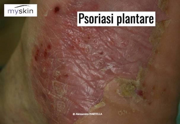 Psoriasi: quanto è grave? il PASI e il GRAVE di Myskin | Myskin