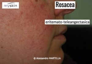 Rosacea: cause, sintomi e terapia | Myskin