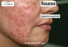 Rosacea: cause, sintomi e terapia | Myskin