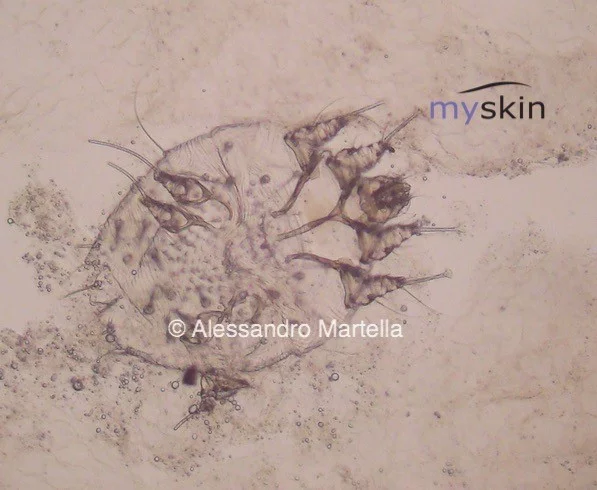 La scabbia: cause e sintomi - Myskin - Dermatologi Online
