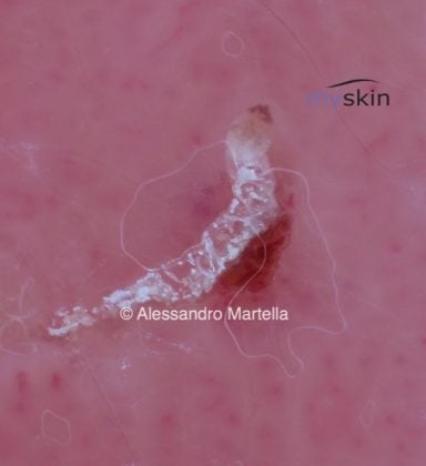 Scabbia: sintomi, diagnosi e terapia | Myskin