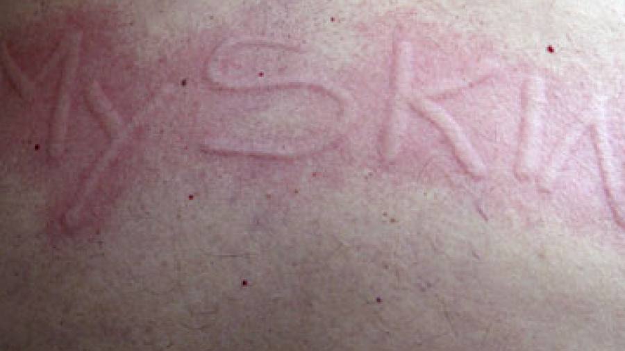 Bianco, rosso... nero: il dermografismo | Myskin