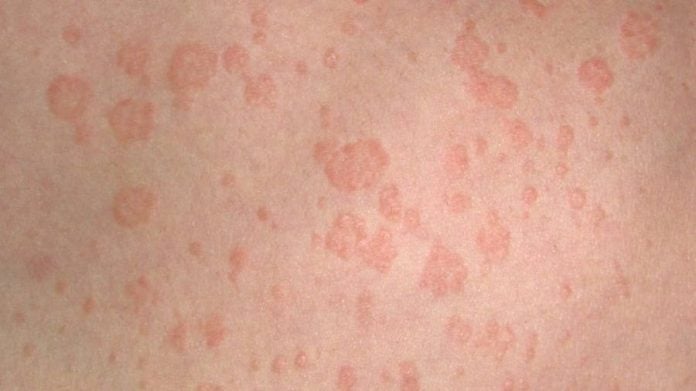 Pitiriasi Versicolor: il mistero delle macchie bianche | Myskin ...