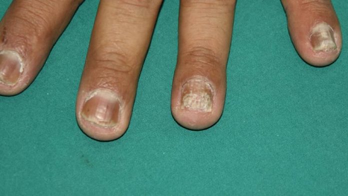 Psoriasi ungueale (delle unghie): guida completa delle manifestazioni ...