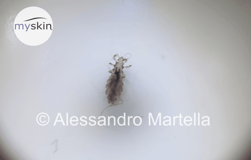 Come eliminare i pidocchi: la pediculosi cosa fare | Myskin