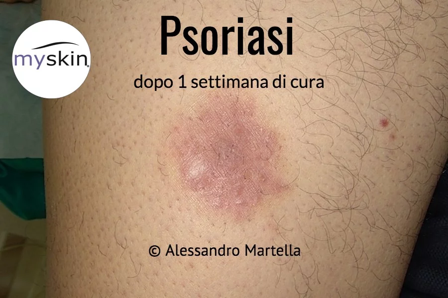 La Psoriasi si cura! - Myskin - Dermatologi Online