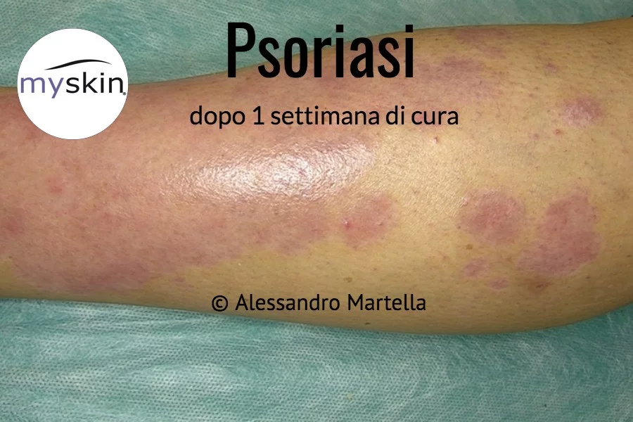 La Psoriasi si cura! - Myskin - Dermatologi Online