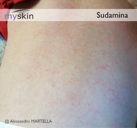 Sudamina: come prevenirla! | Myskin