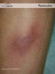 Panniculite : sintomi e cura | Myskin