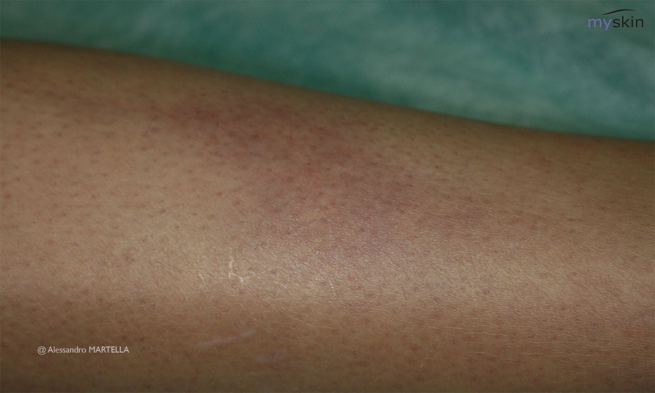 Panniculite : sintomi e cura | Myskin