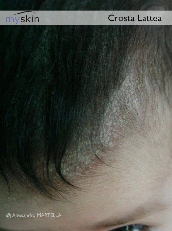 Crosta lattea del neonato : sintomi e trattamento - Myskin ... Crosta lattea del neonato : sintomi e trattamento - Myskin ...