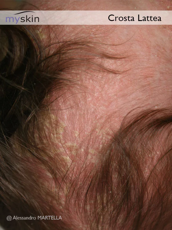 Crosta lattea del neonato : sintomi e trattamento - Myskin ...