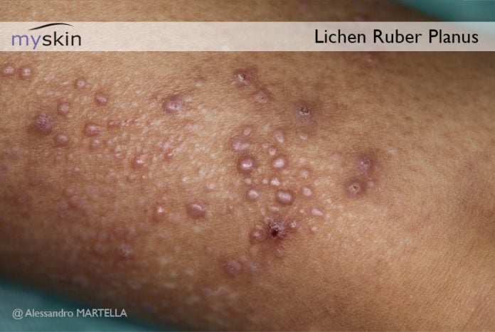 Lichen planus: sintomi e trattamento | Myskin