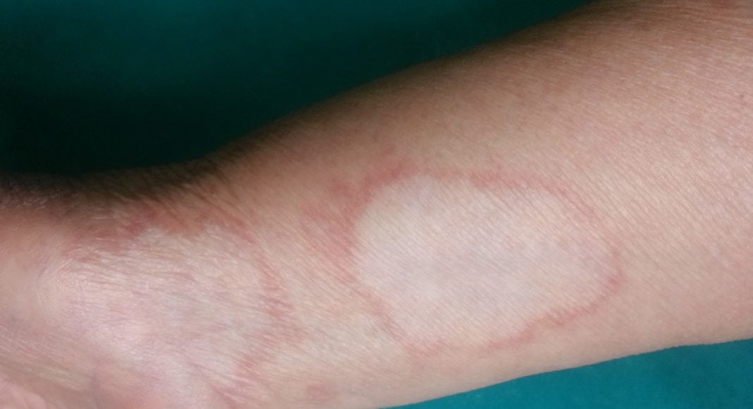 Morfea : cause, sintomi e trattamento | Myskin - Dermatologi Online