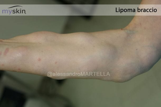 Lipoma: sintomi, cause e asportazione | Myskin