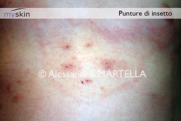 Puntura di insetto: cosa fare | Myskin