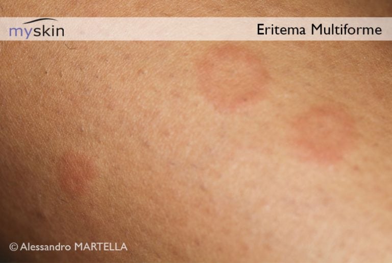 Eritema multiforme: come riconoscerlo e curarlo | Myskin