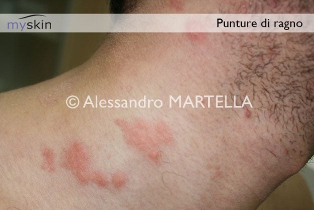 Puntura di insetto: cosa fare | Myskin