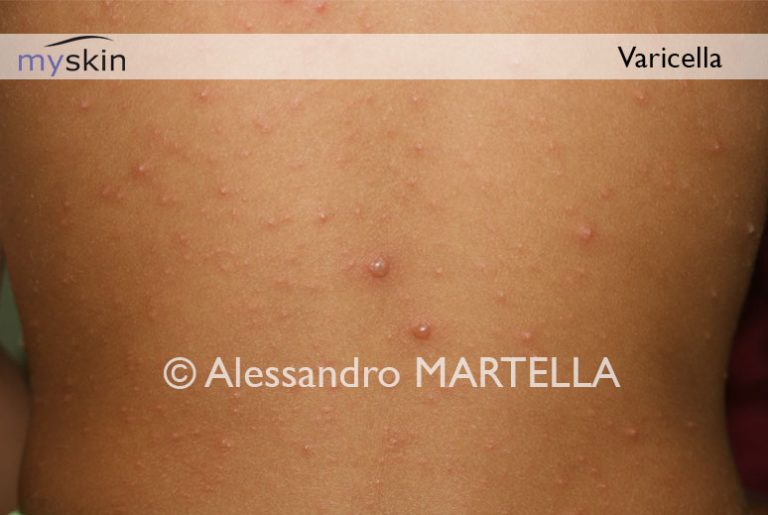 Varicella vs Morbillo: come riconoscerle e come curarle | Myskin
