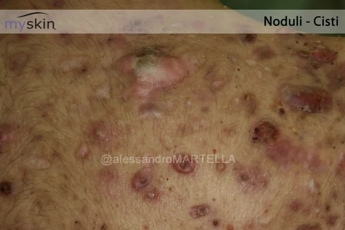 Che tipo di Acne hai? - Myskin - Dermatologi Online