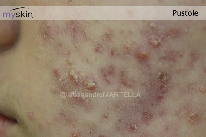 Che tipo di Acne hai? - Myskin - Dermatologi Online