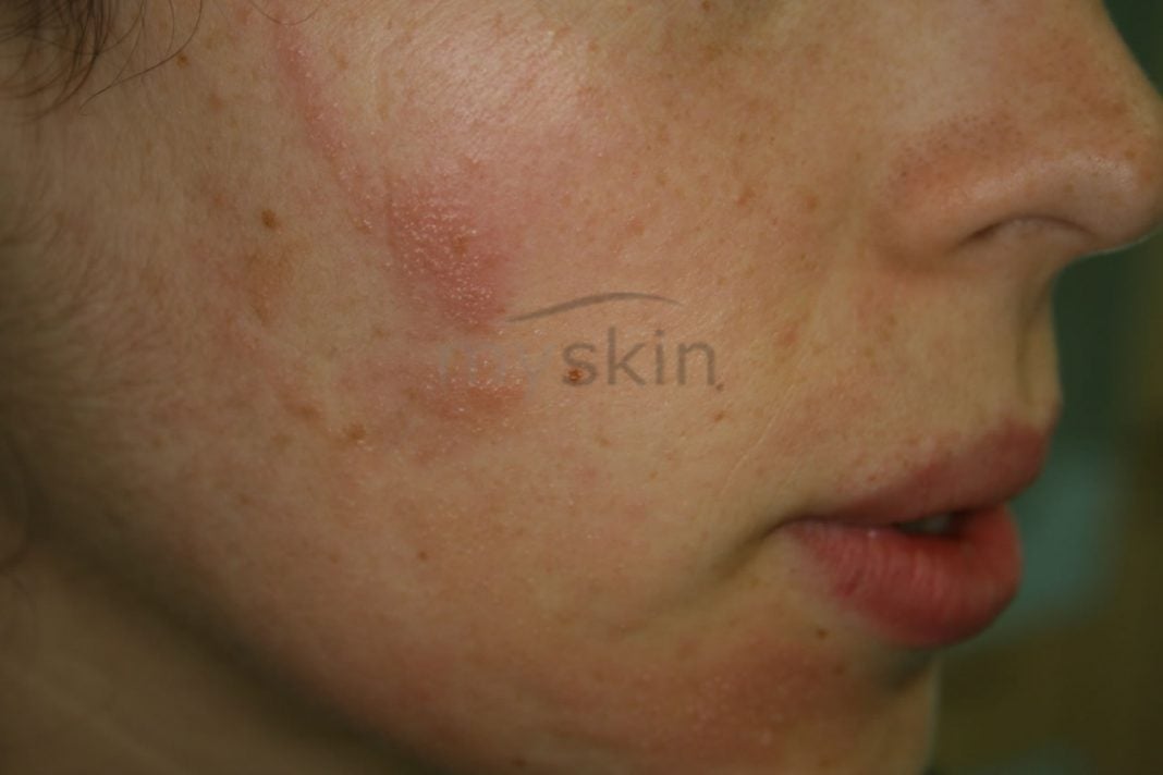 Dermatite allergica da contatto: sintomi e cura | Myskin - Dermatologi ...