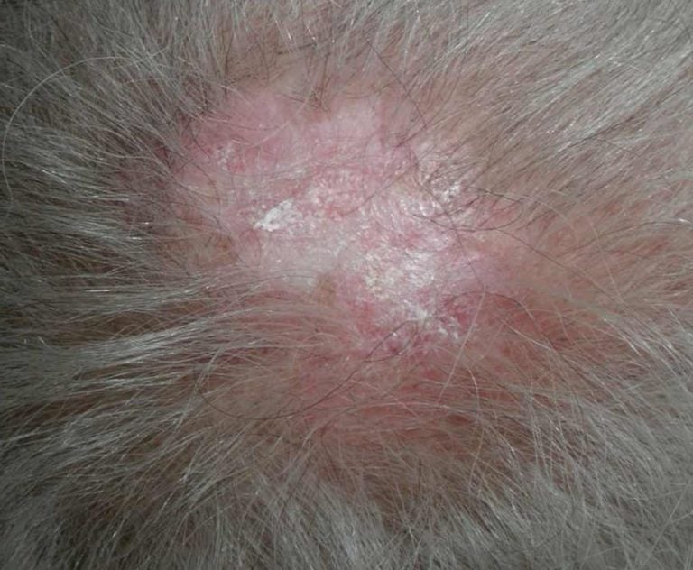 Patologia Lupus Myskin Dermatologi Online