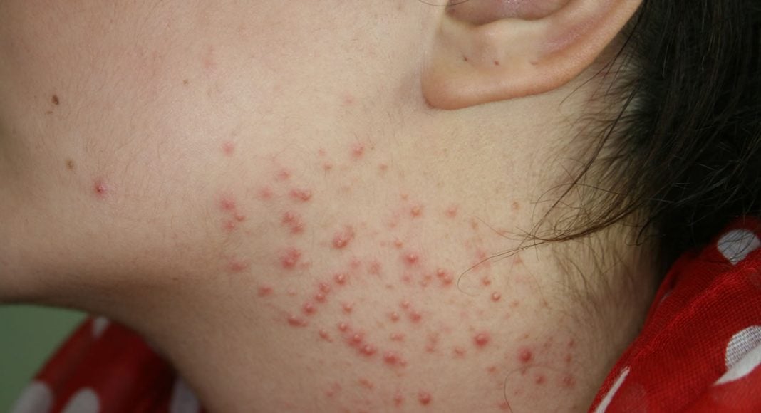 Follicolite: cause e rimedi | Myskin - Dermatologi Online