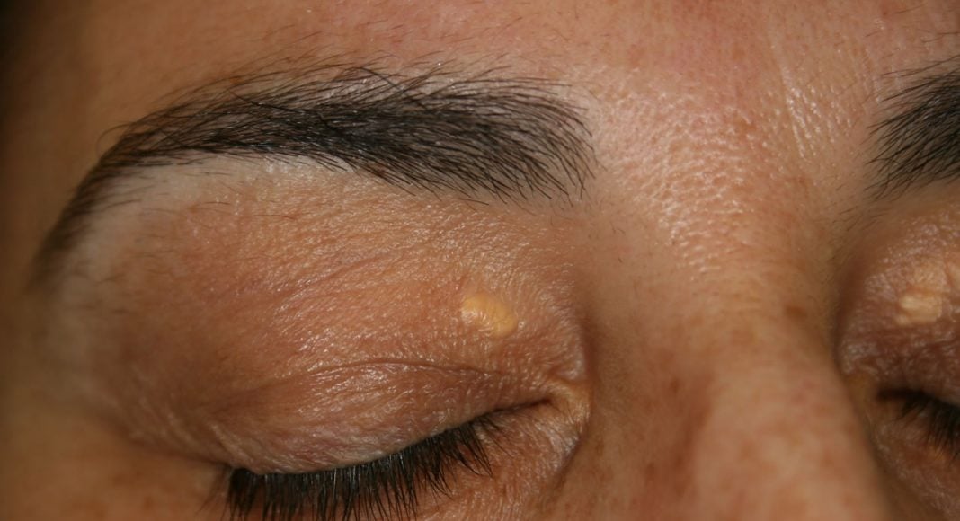 Xantelasma: cause e trattamento | Myskin - Dermatologi Online
