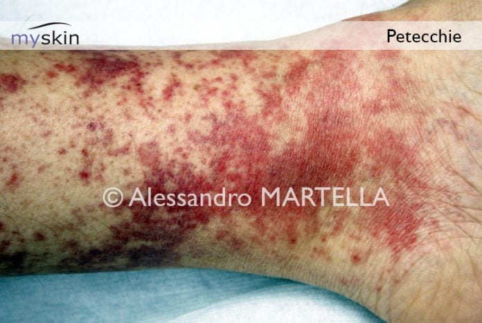 Petecchie : quelle macchie viola sulla pelle | Myskin
